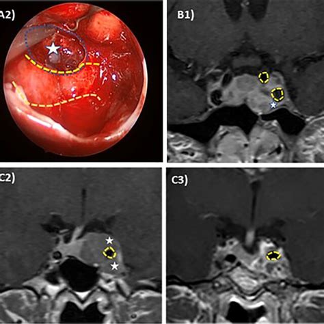 Hardywilson And Knosp Classifications Hardywilson Classification Download Scientific Diagram