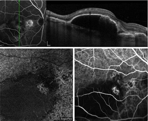 Provides An Example Of How Oct A Image The Choroidal Network In A Case Download Scientific