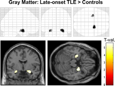Significant Voxel Wise Differences In Gray Matter Volume Between