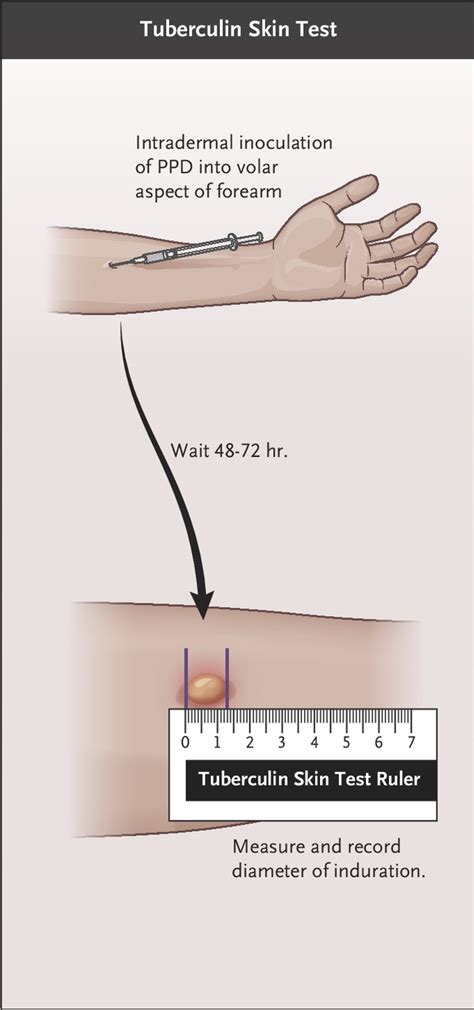 تست Ppd آزمایشگاه ژن لند تهران