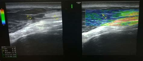 Ultrasound Elastography Shows E1 E2 Ratio 0 7 Download Scientific Diagram