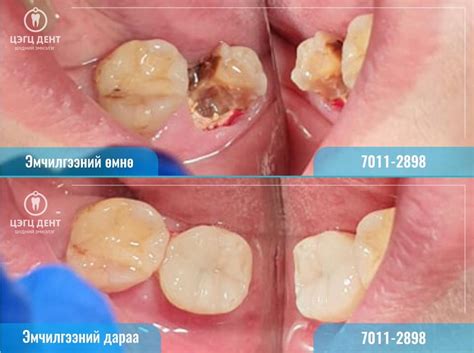 Шүдээ авхуулаад байх биш өөрийн Цэгц Дент шүдний эмнэлэг