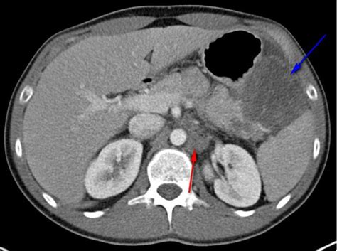 Figure 2 From A Case Of Desmoplastic Small Round Cell Tumor Semantic