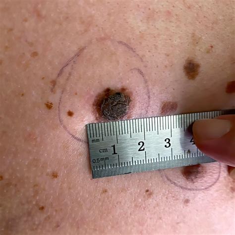Mole Check Albuquerque Nm Skin Cancer Screening Skymd