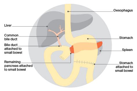 Whipple Procedure Diagram