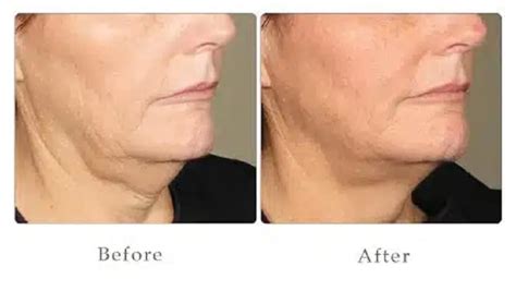 Ultherapy Ivory Aesthetics Clinic