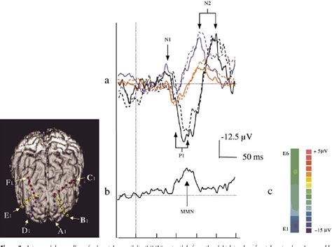 Figure From Application Of EEG ERP And Intracranial Recordings To The Investigation Of
