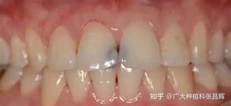 邻面龋一颗坏成俩，不可轻视！ 知乎