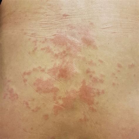 Intradermotest And Prick Test To Rule Out Autoimmune Progesterone
