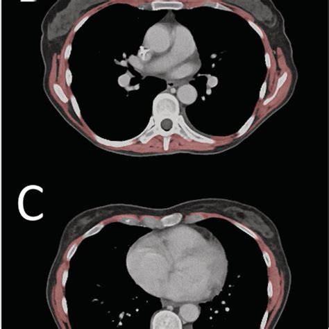 Illustration Skeletal Muscle Segmentation Red At The Level Of The
