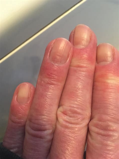 Negative Scleroderma Ssc Panel Any Suggestions Please On What To Try