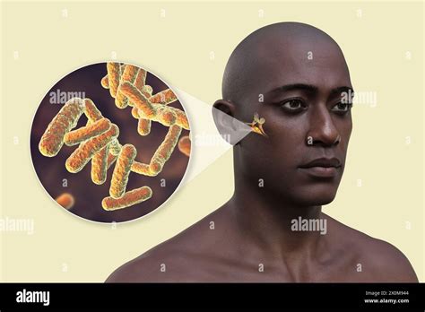 3d Illustration Of A Man With A Bacterial Infection Of The Middle Ear