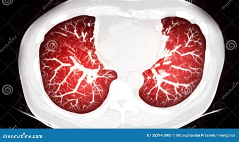 Ct Chest Scan Overview Shows Clear Lung Fields Heart And Mediastinum