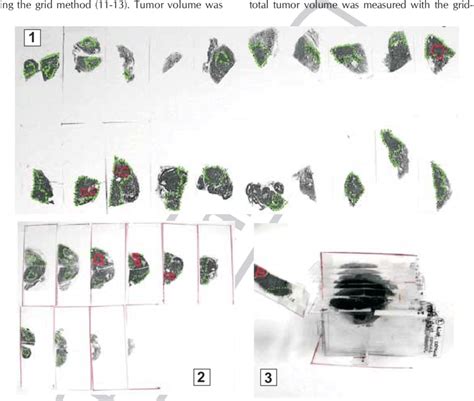 Three Steps In Three Dimensional Reconstruction Of The Prostate From
