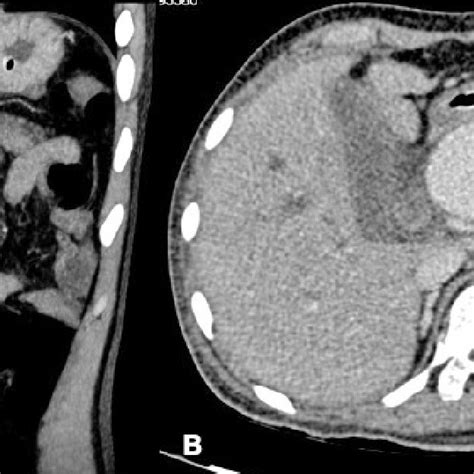 Saccular Pseudoaneurysm Arising From Common Hepatic Artery As Seen Download Scientific
