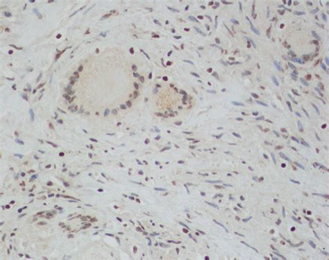 Pulmonary Tuberculosis Pathological Staining A B Distal Side