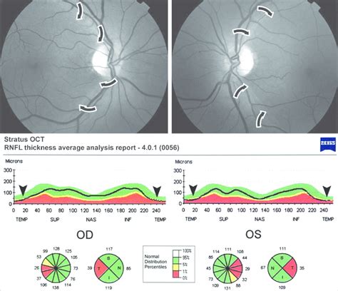 Case 1 Above Fundus Photography Showing Temporal Optic Disc Pallor