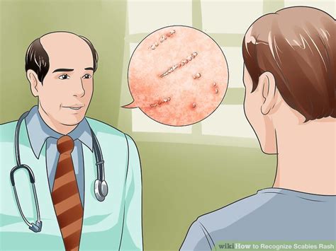 How To Recognize Scabies Rash With Pictures WikiHow