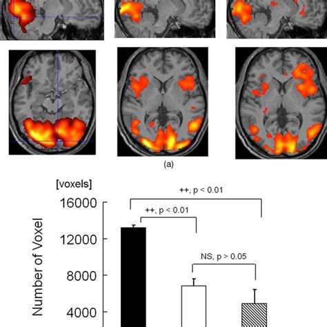 Pdf Fmri Evidence Of Improved Visual Function In Patients With Progressive Retinitis