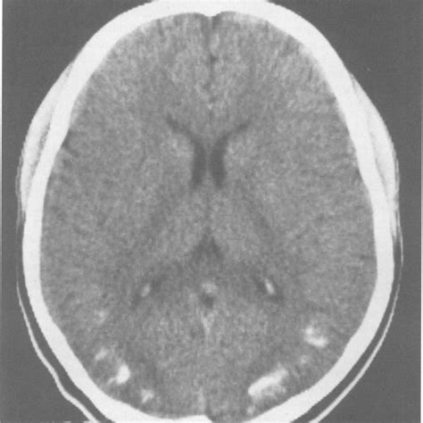 Case 1 Ct Scan Showing Cortico Subcortical Bilateral Calcification In