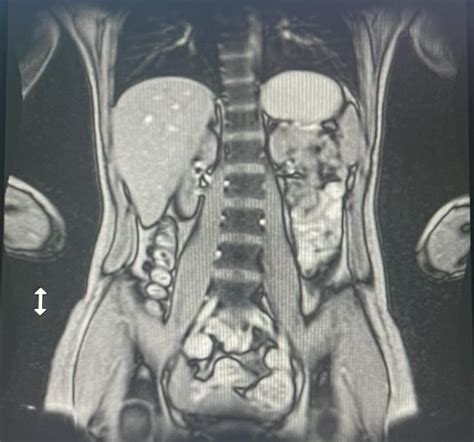 Bilateral Sciatica But Mri Shows Everything Normal R Sciatica