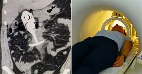 Horror MRI Accidents From Crushed Nurse To Sex Toy Dragged Through Body World News Mirror