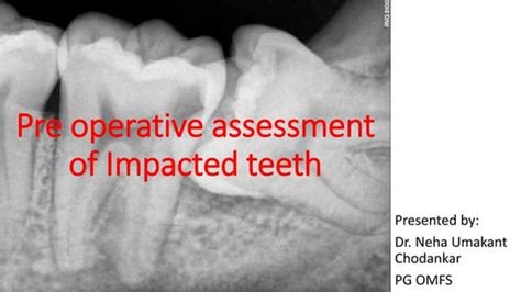 Radiographic Assessment Of Impacted Teeth Pptx