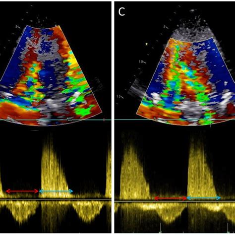 Color Doppler Imaging Continuous Doppler Echocardiography AC Color Download Scientific