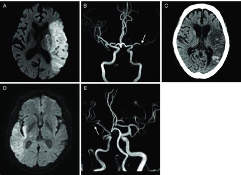 A Diffusion Weighted MRI Shows Diffusion Restriction In The Left Download Scientific Diagram
