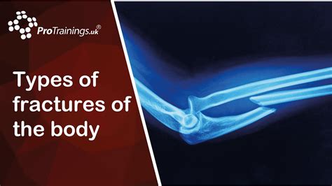 Types Of Fractures Of The Body First Aid Information YouTube