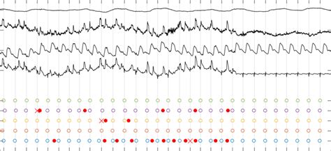 Transition Area Of Noisy And Clean Parts Of A Record The Noisy Segment Download Scientific