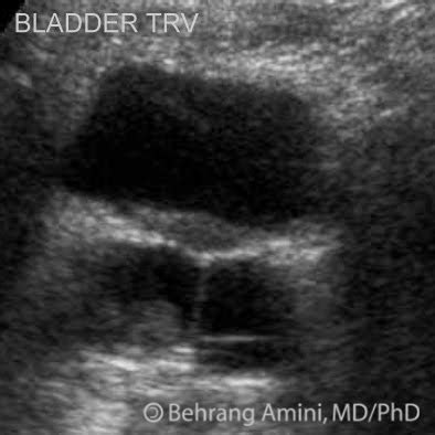 Roentgen Ray Reader Seminal Vesicle Cysts