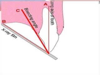 Parallel Angle Technique Vs Bisecting Angle Technique PPTX Dental Health Diseases And