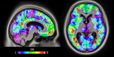 New Algorithm Can Detect Early Signs Of Dementia Years Ahead Of Symptoms Ictandhealth Global