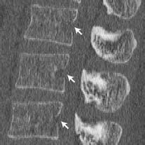 Detection And Segmentation Of Vertebrae From CT Images Is A Challenging Download Scientific