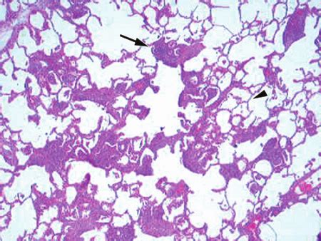 Lymphoid Interstitial Pneumonia Photomicrograph Original