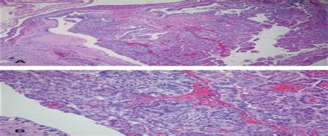 Choroid Plexus Papilloma Arising In A Mature Cystic Teratoma