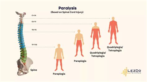 Paralysis Chart