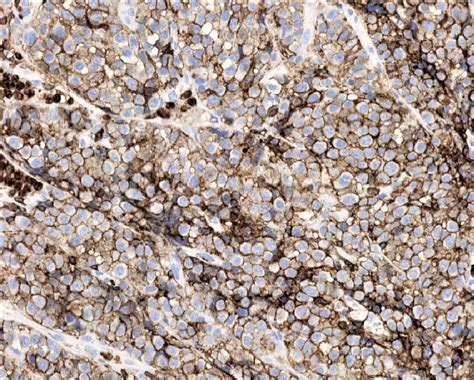 Pathology Outlines Cd45 Lca
