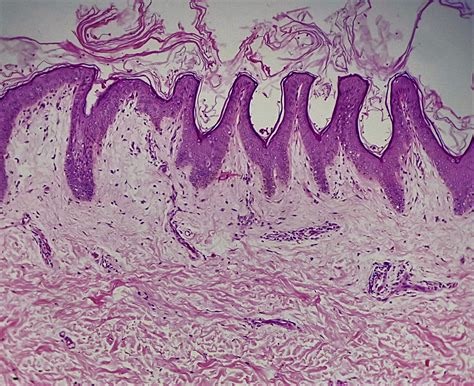Mild Confluent And Reticulated Papillomatosis 20163 18 Our