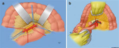 Technique Of Open Mesenteric Catheter Embolectomy Thoracic Key