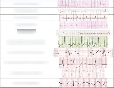 Ekg Interpretation Diagram Quizlet
