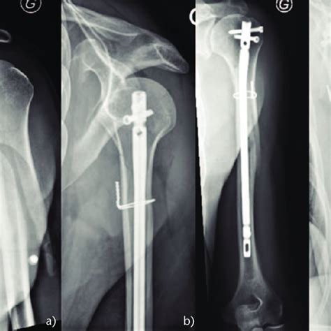 A Proximal Third Oblique Fracture B Nail With Cerclage Wire C Download Scientific