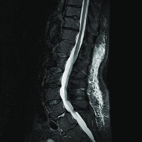 Whole Spine Magnetic Resonance Imaging Showing Paraspinal Muscle Download Scientific Diagram