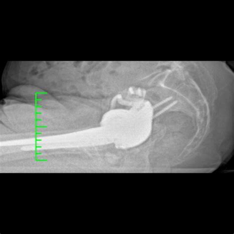 Case 27 Revision Of A Loose Cup Due To Massive Superior Acetabular Osteolysis From Polyethylene