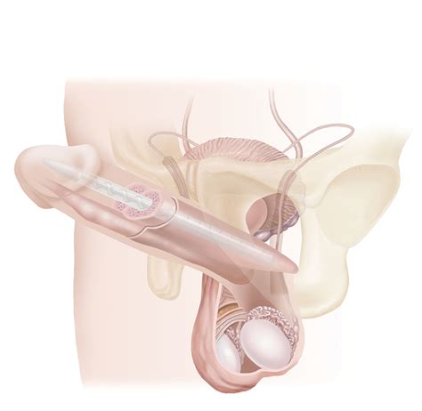 Penile Implants Advanced Urology Institute At Titus