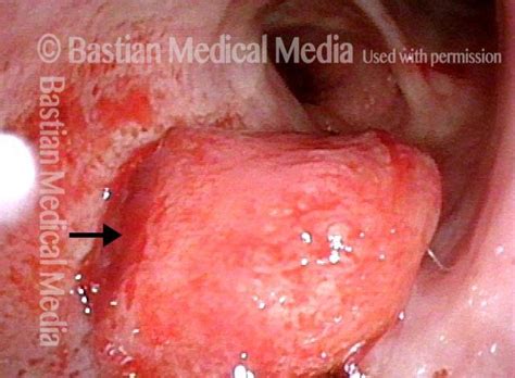 Trachea Laryngopedia