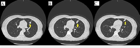 chest ct scan spatial resolution 512 × 512 and slice thickness 1 25