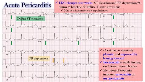 Pericardite Ecg 1000x750