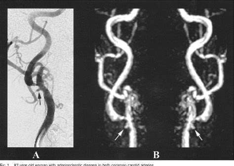 Figure 1 From Time Resolved Contrast Enhanced Carotid Mr Angiography Using Sensitivity Encoding